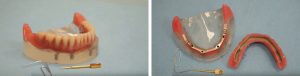 PEEK dentures Implant-supported dental prosthesis